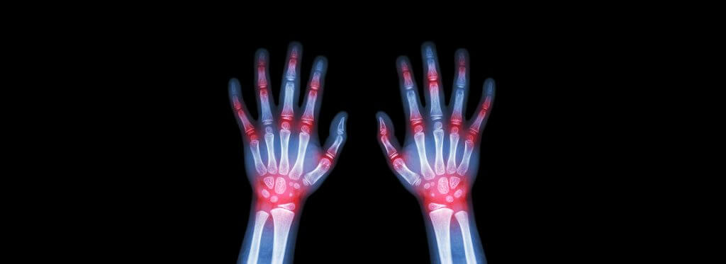 Ulnar Impaction Syndrome (UIS) | What is Ulnar Impaction Syndrome?