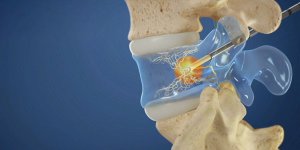 Intracept Procedure For Chronic Low Back Pain | Intracept Spine Surgery ...