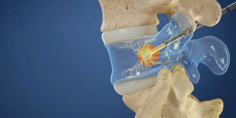 Intracept Procedure For Chronic Low Back Pain | Intracept Spine Surgery Near Me